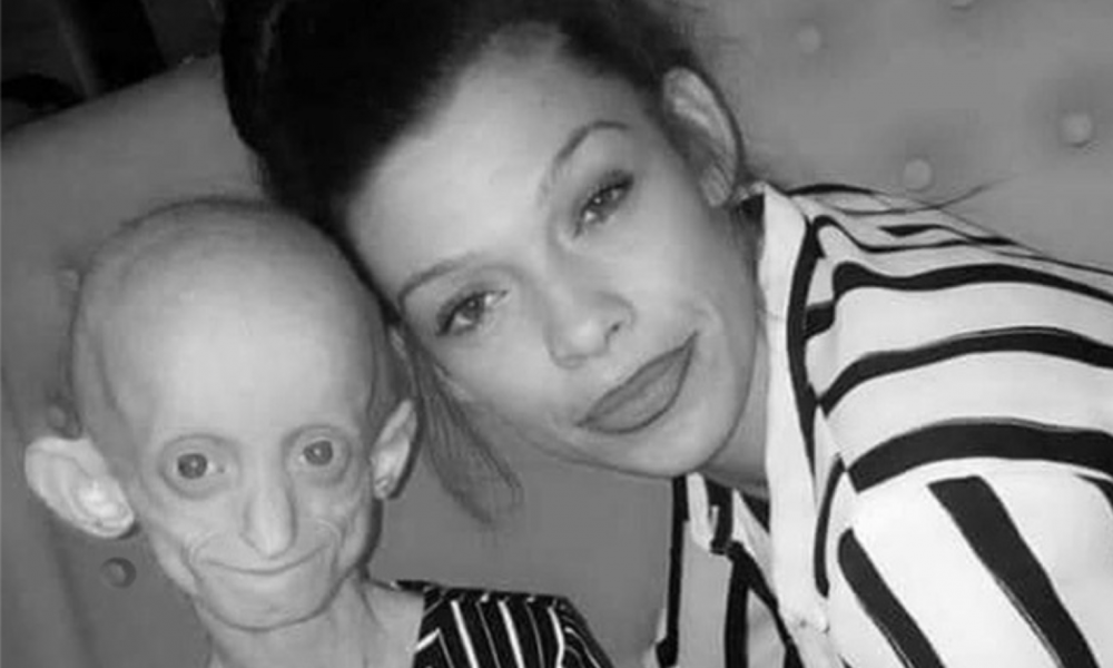 18-year-old with Benjamin Button disease that aged her body to 144 has ...