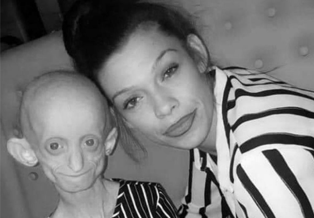 18-year-old with Benjamin Button disease that aged her body to 144 has ...